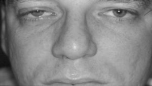 Trigeminal Autonomic Cephalalgias (TACs) - Neuropedia