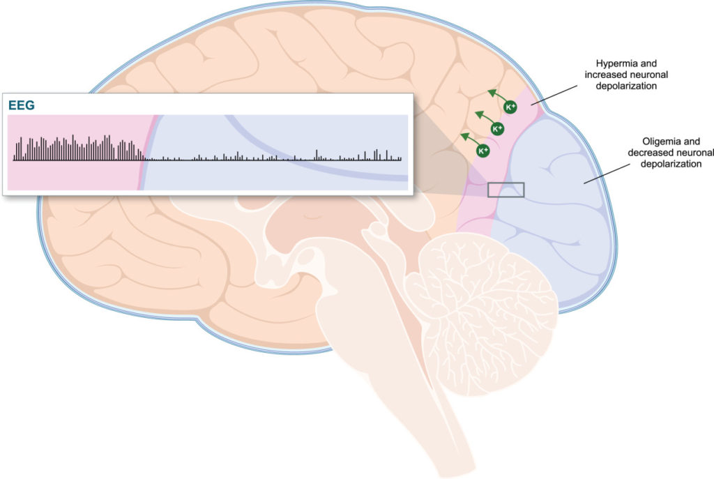 Migraine - Neuropedia - Neuropathology Migraine attacks