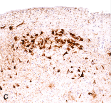 Alzheimer's Disease - Neuropedia - Neuropathology