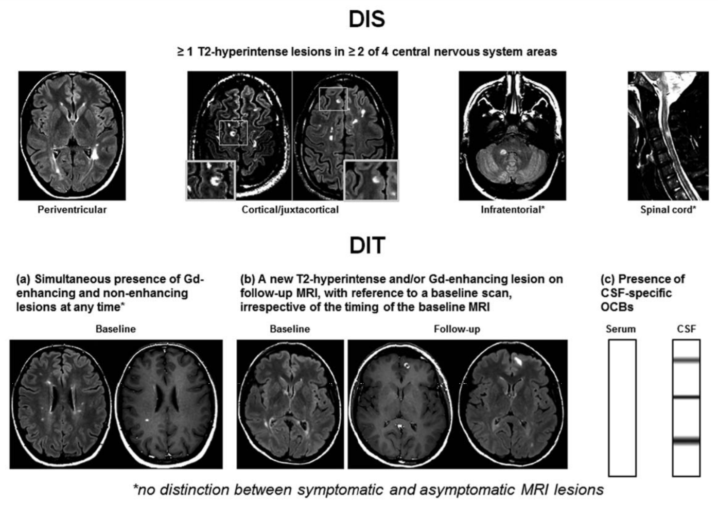 Multiple Sclerosis - Neuropedia - Neuropathology MS