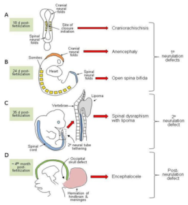 Neural Tube Defects - Neuropedia - Neuropathology