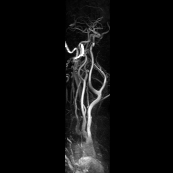 Carotid Body Tumors - Neuropedia - Neuropathology