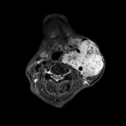 Carotid Body Tumors - Neuropedia - Neuropathology