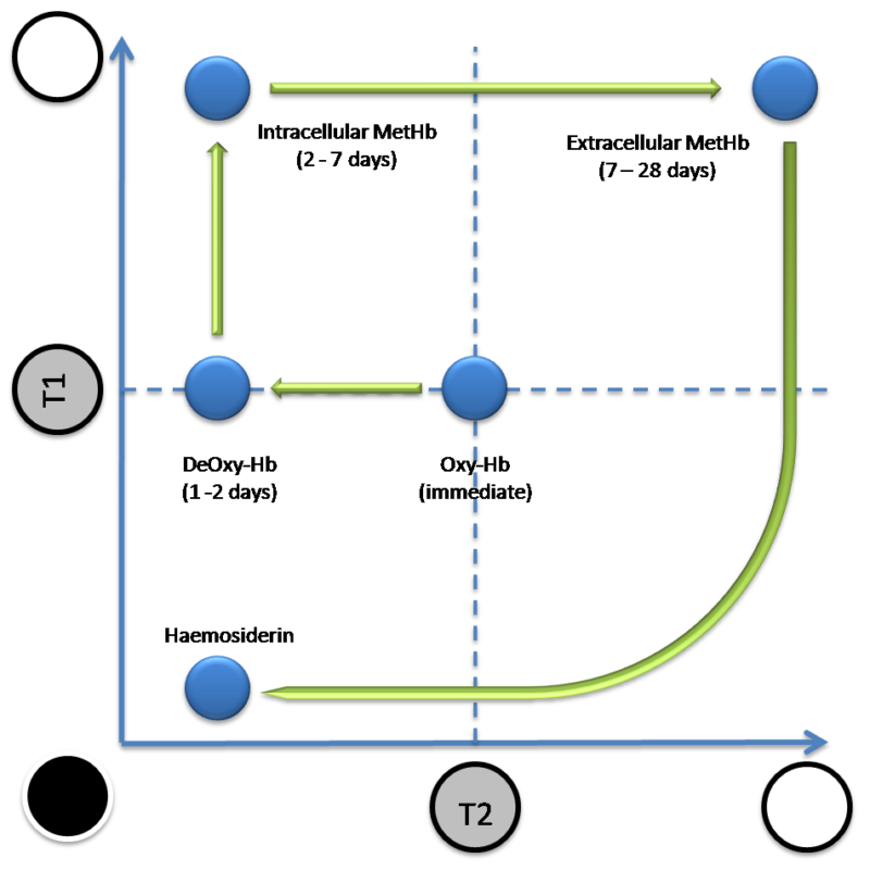 Intracerebral Hemorrhage (ICH) - Neuropedia - Neuropathy