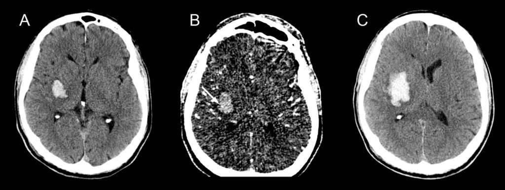 Intracerebral Hemorrhage (ICH) - Neuropedia - Neuropathy