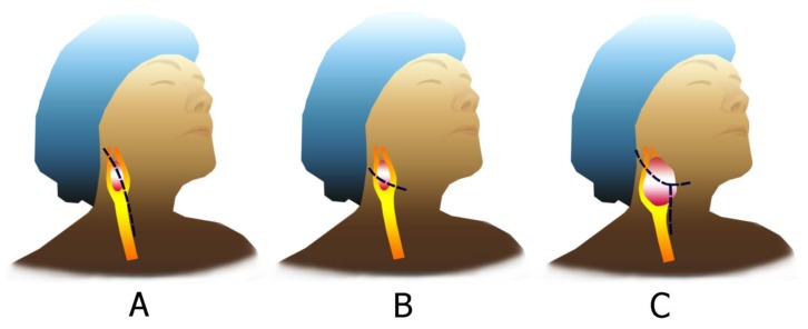 Carotid Body Tumors - Neuropedia - Neuropathology