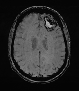 Intracerebral Hemorrhage (ICH) - Neuropedia - Neuropathy