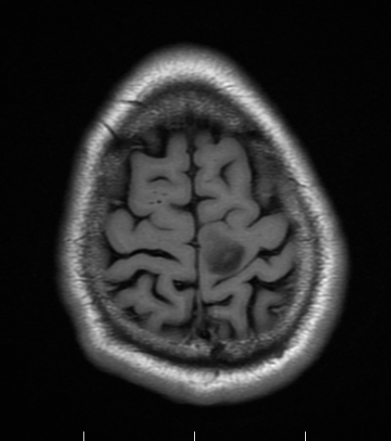 Low Grade Glioma - Neuropedia