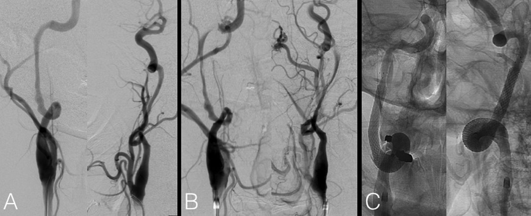 Non-Atherosclerotic Carotid Artery Lesions - Neuropedia