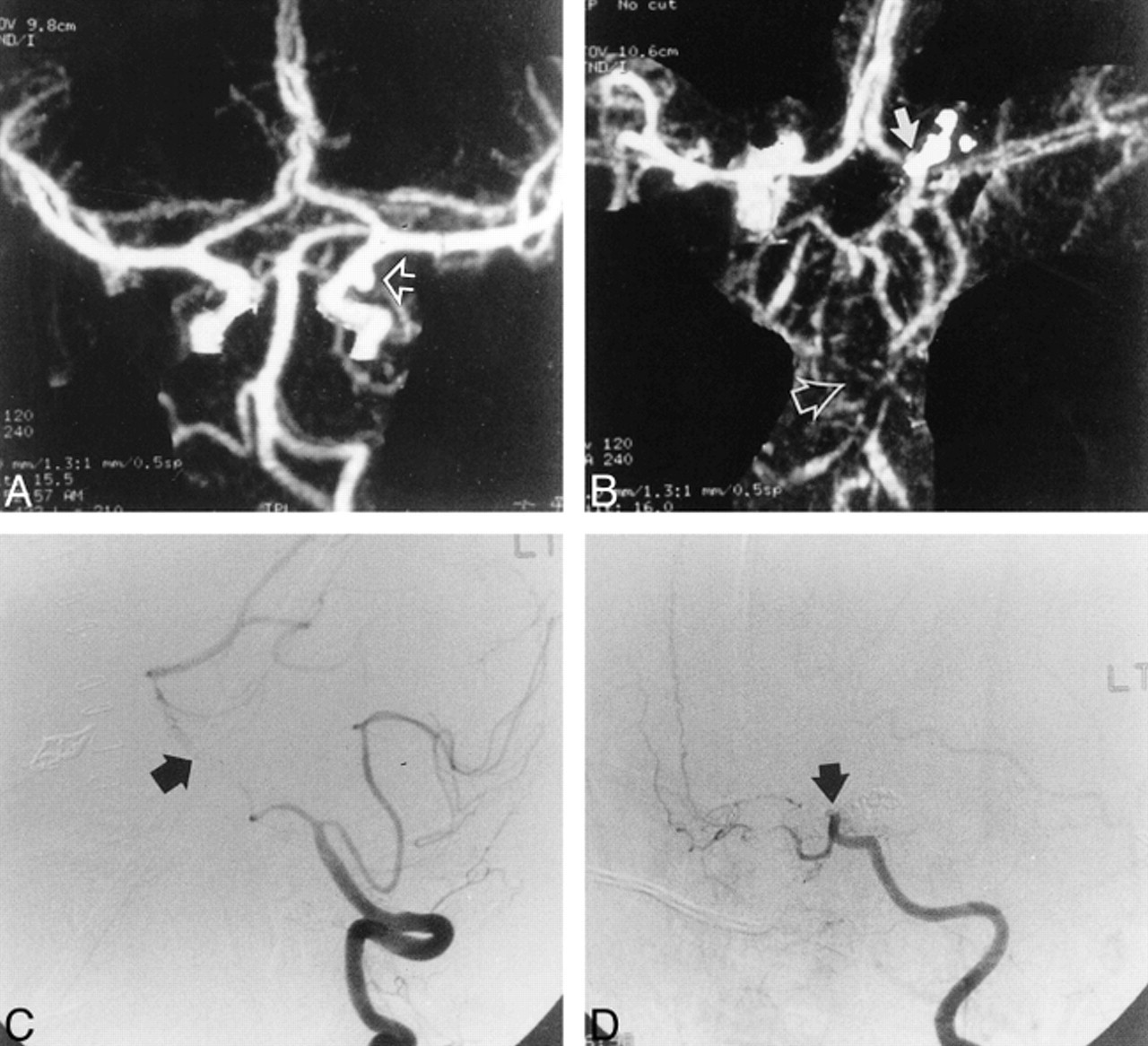 Cerebral Vasospasm - Neuropedia