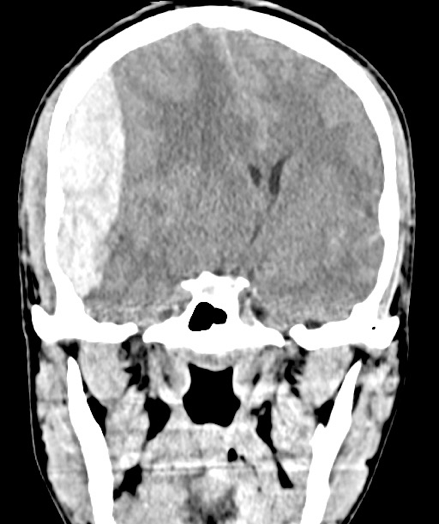 Epidural Hematoma - Neuropedia