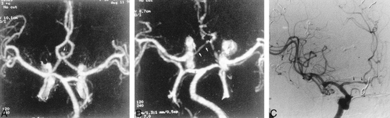 Cerebral Vasospasm - Neuropedia