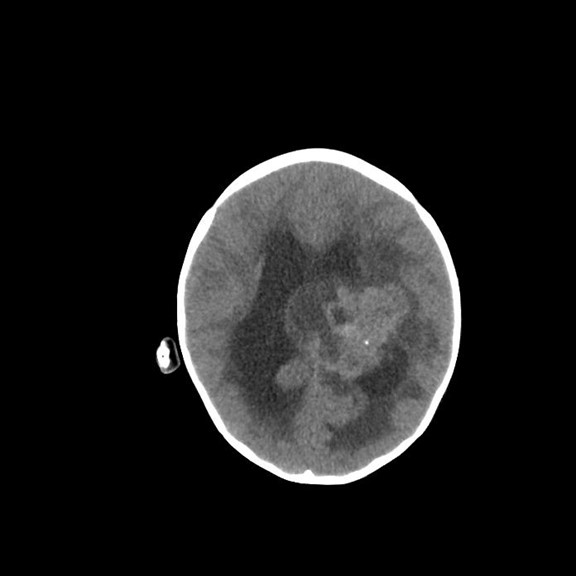 Primary Neuroectodermal Tumors (PNET) - Neuropedia