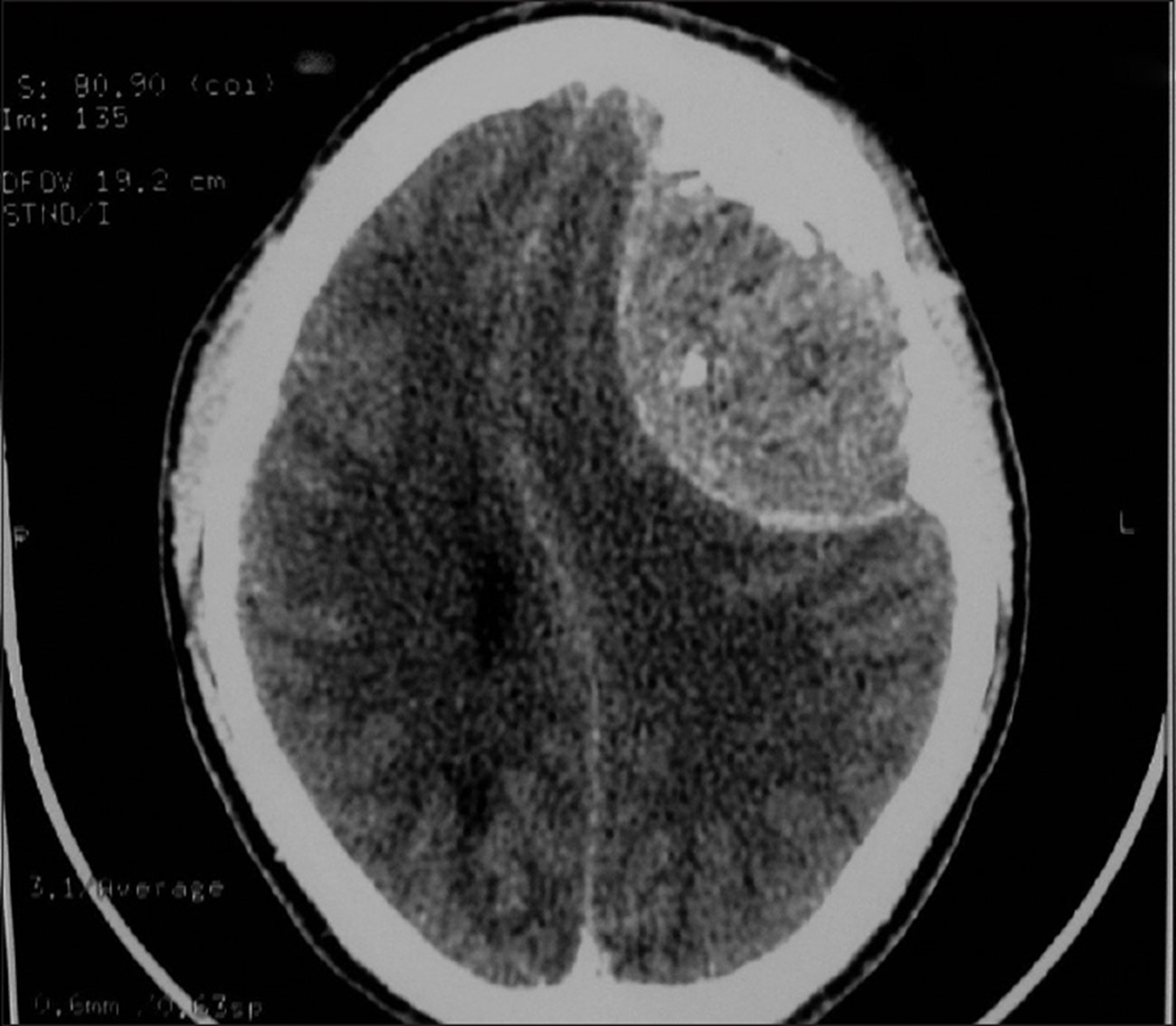 Primary Neuroectodermal Tumors (PNET) - Neuropedia