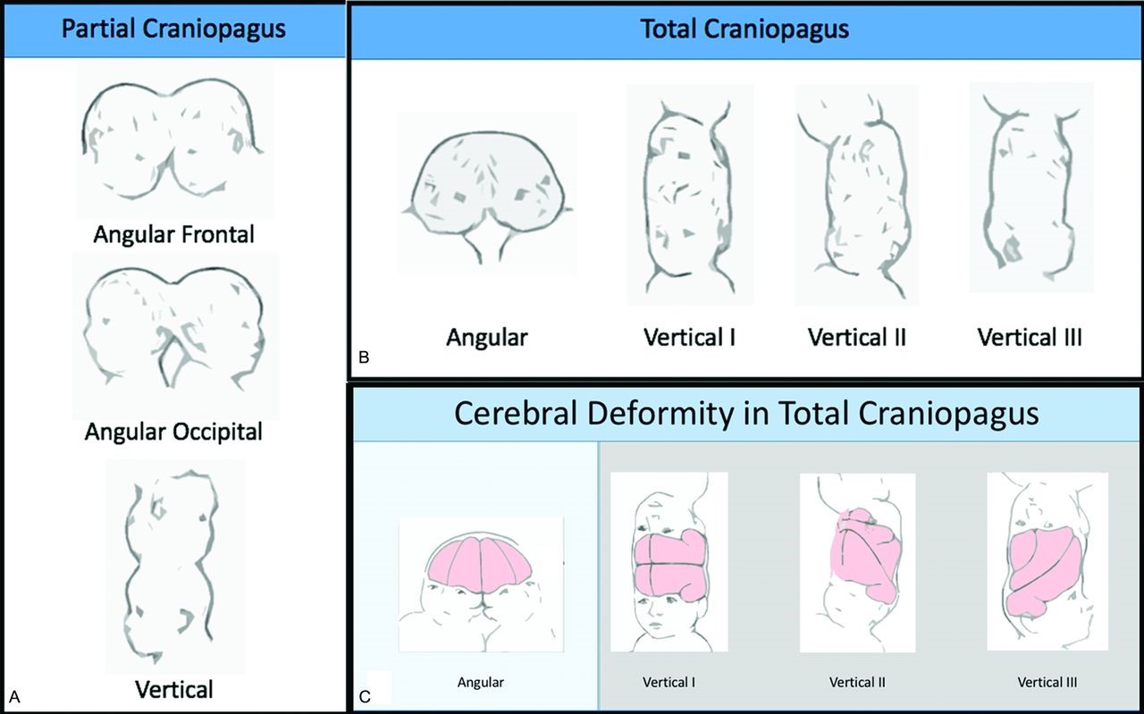 Craniopagus Twins - Neuropedia