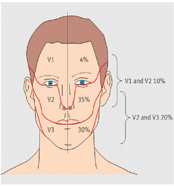 Trigeminal Neuralgia Neuropedia