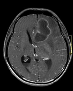 Brain Abscess (BA) - Neuropedia