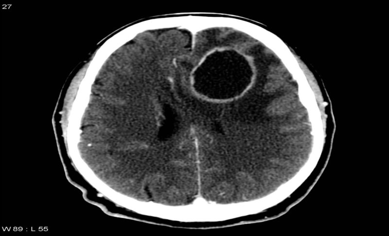 Brain Abscess (BA) - Neuropedia