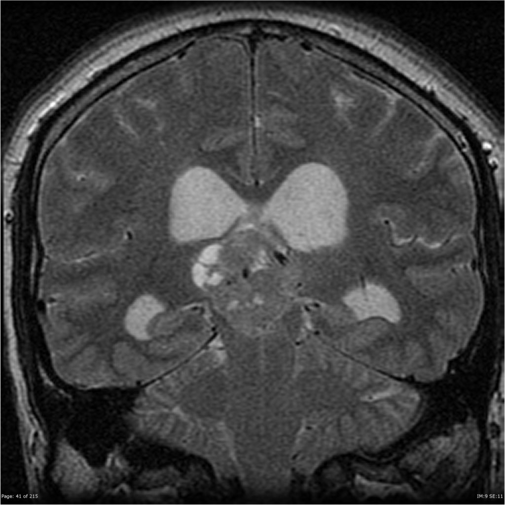 Neuropedia - Neurosurgery - Oncology - Pineal Gland Tumors