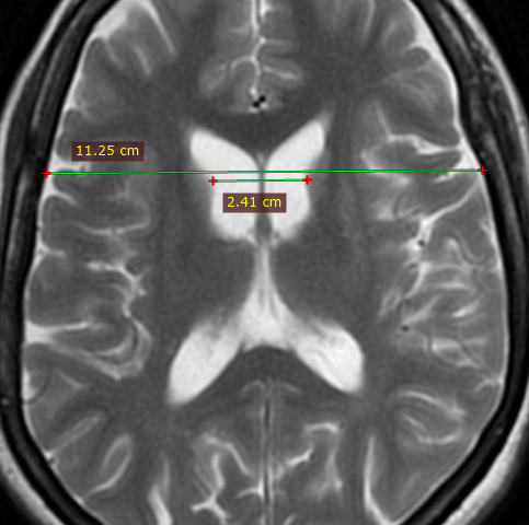 Huntington's Disease - Neuropedia