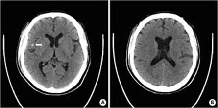 Intraventricular Brain Hemorrhage - Neuropedia