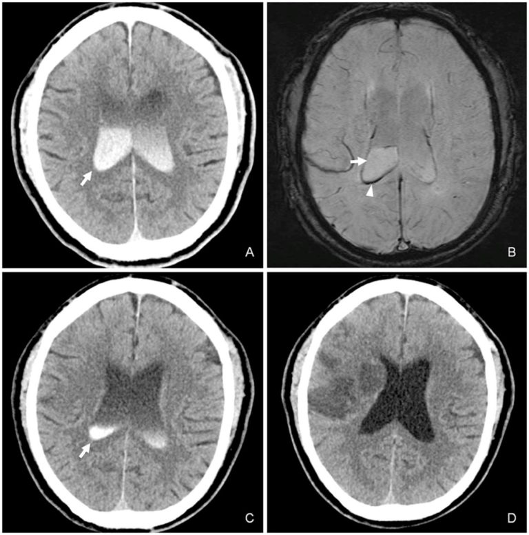 Intraventricular Brain Hemorrhage - Neuropedia