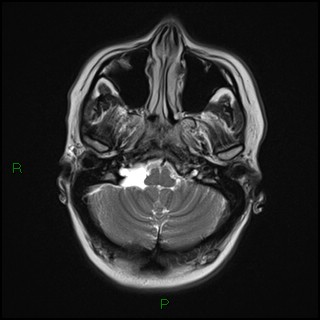 ARACHNOID CYSTS - Neuropedia
