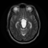 ARACHNOID CYSTS - Neuropedia
