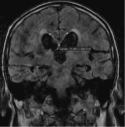 Normal Pressure Hydrocephalus (NPH) - Neuropedia