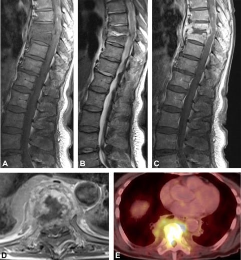Spondylodiscitis - Neuropedia