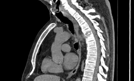 Spondylodiscitis - Neuropedia