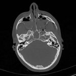 Skull Fractures - Neuropedia