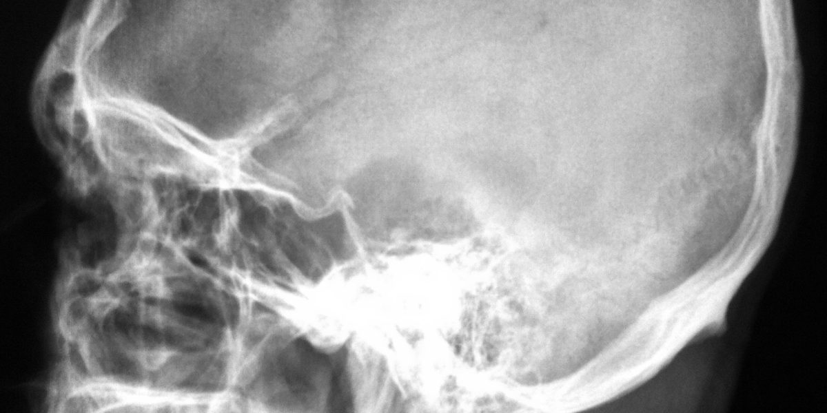 Skull Fractures - Neuropedia