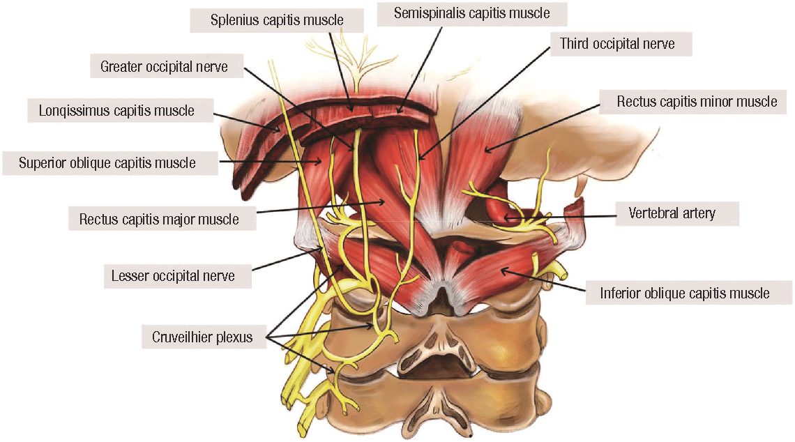 Occipital Neuralgia Neuropedia