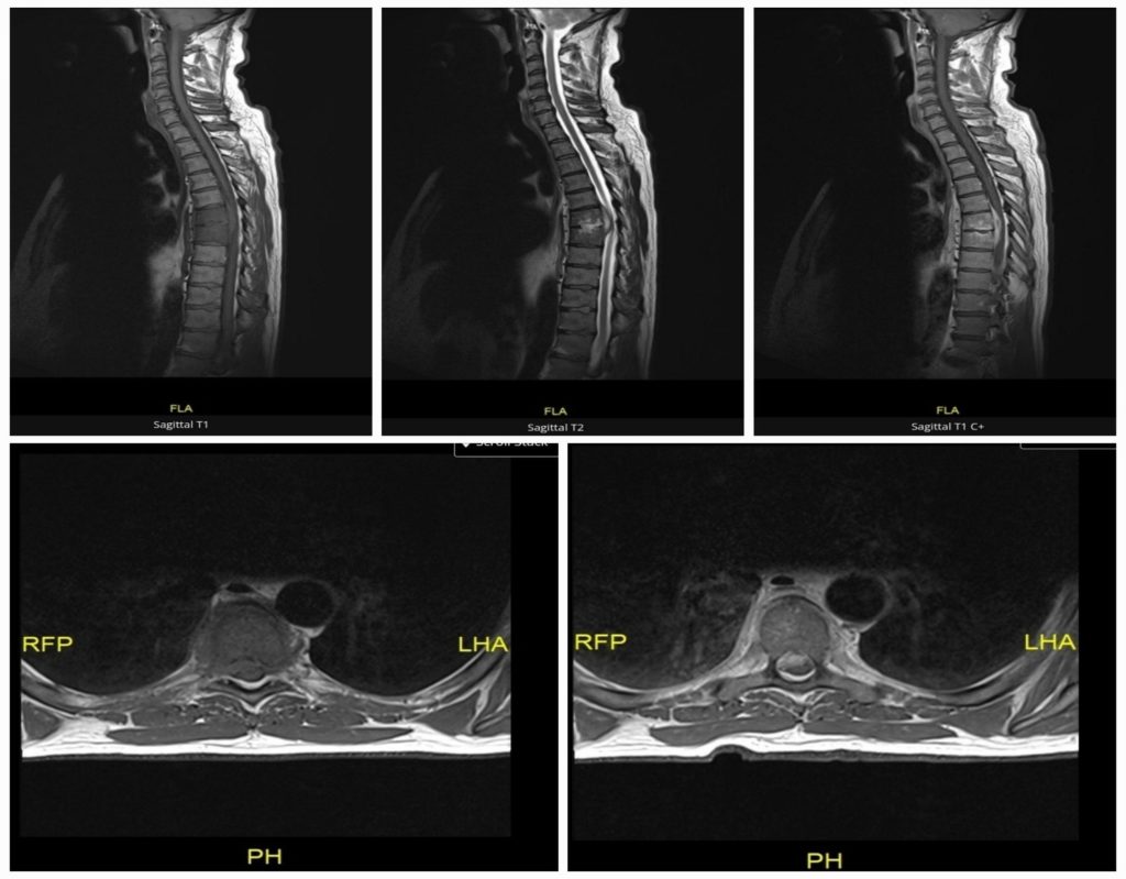 Epidural Abscesses - Neuropedia