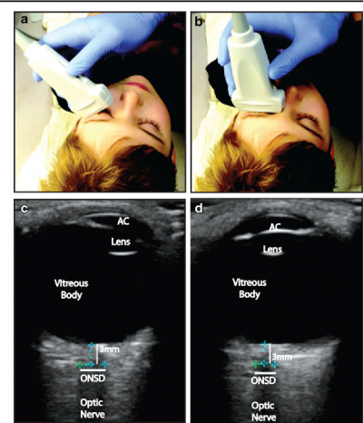ICP Monitoring: Types and Indications - Neuropedia