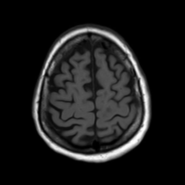 Highly Aggressive Multiple Sclerosis - Neuropedia