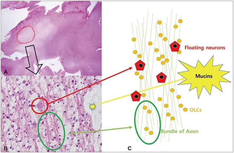Dysembryoplastic Neuroepithelial Tumor (DNET) - Neuropedia