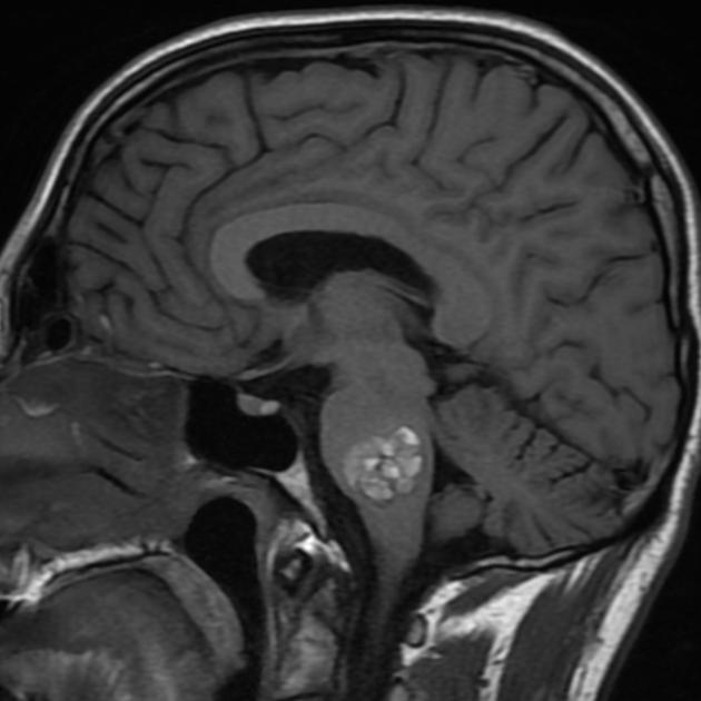 Brainstem Cavernoma - Neuropedia