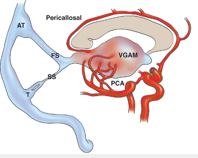 Vein of Galen Malformation (VOGM) - Neuropedia