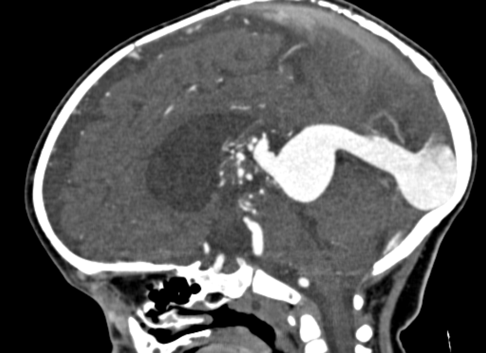 Vein of Galen Malformation (VOGM) - Neuropedia