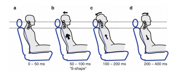 Whiplash-Associated Disorders - Neuropedia