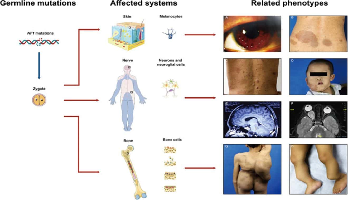 Neurofibromatosis type I - Neuropedia
