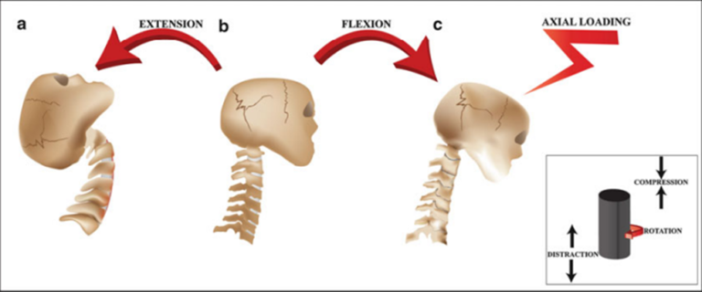 Sport-related Cervical Spine Injuries - Neuropedia
