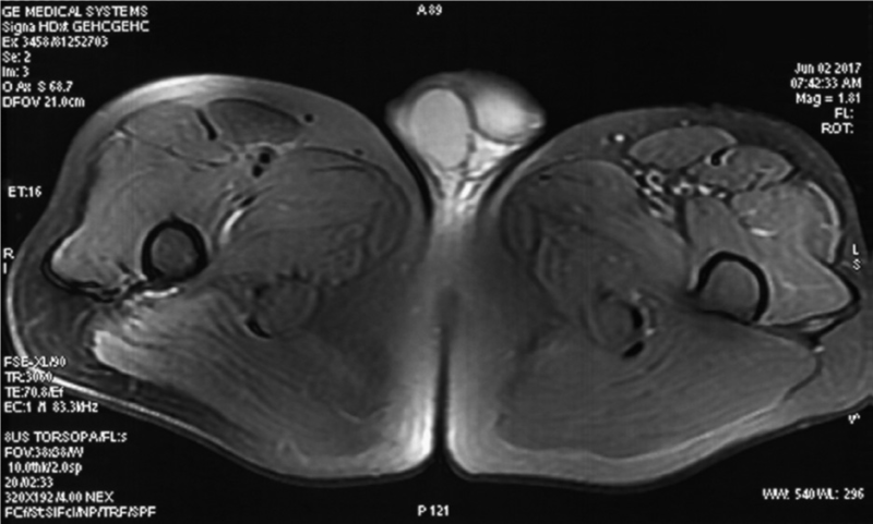 Limb Girdle Muscular Dystrophy - Neuropedia