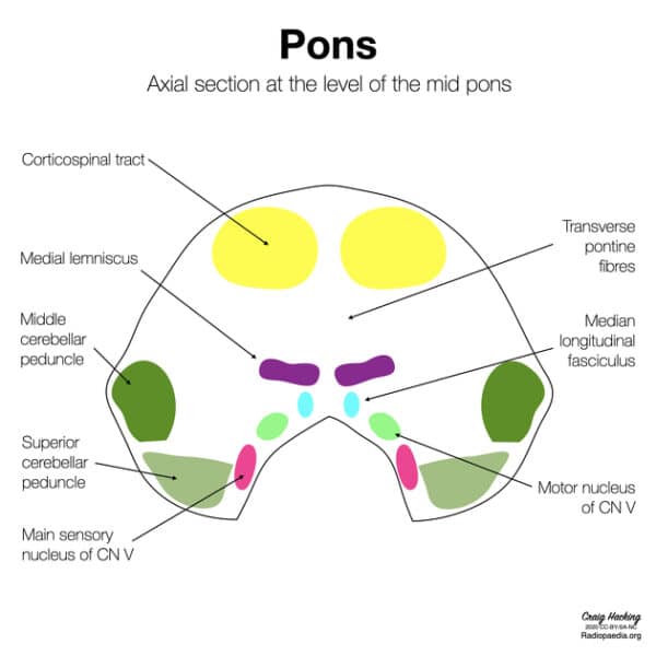 Lateral Pontine Stroke - Neuropedia