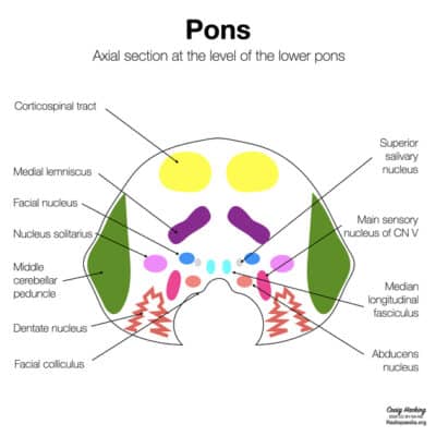 Lateral Pontine Stroke - Neuropedia